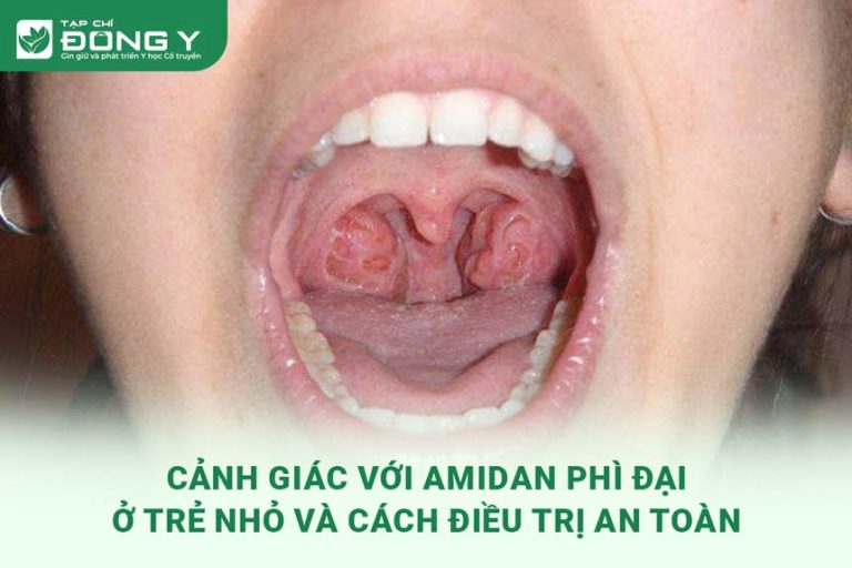 Amidan Phì Đại Ở Trẻ Nhỏ: Nguyên Nhân, Triệu Chứng và Điều Trị